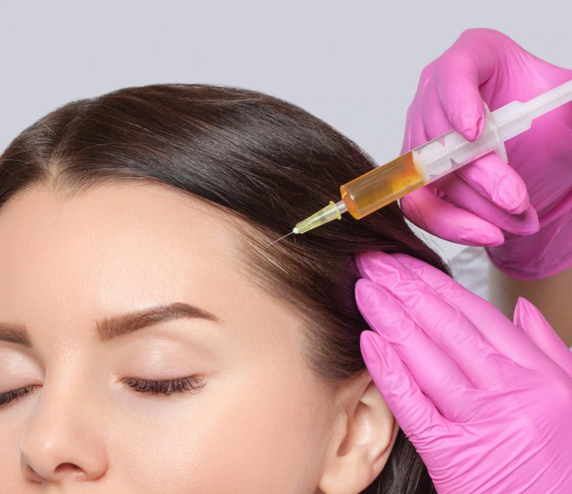 Exosome Treatment For Hair Loss | Toronto, Aurora & Vaughan